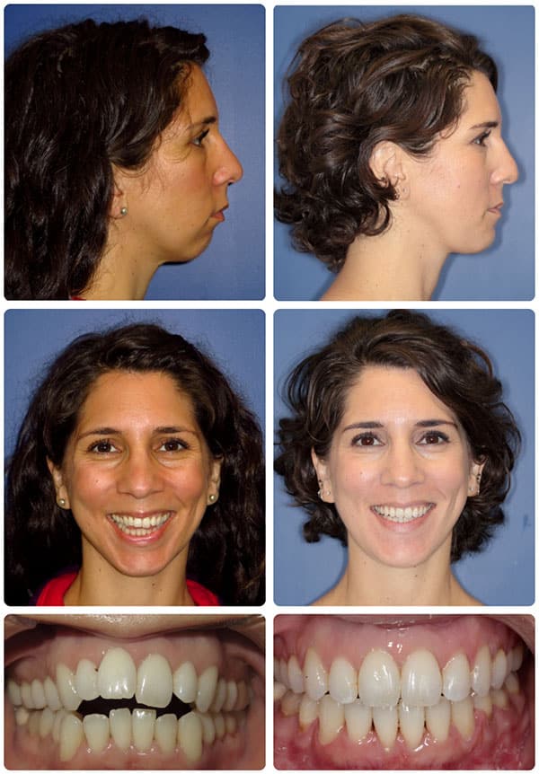 Before and After Orthodontic Results | Sunnyside Orthodontics